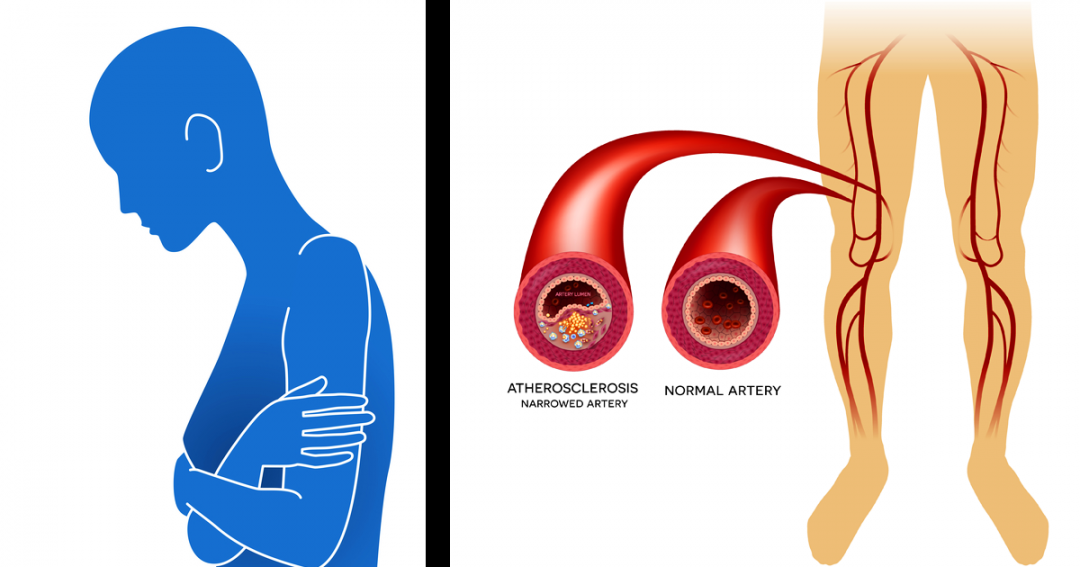 8 Signs and Symptoms You Have Poor Circulation and Peripheral Artery ...