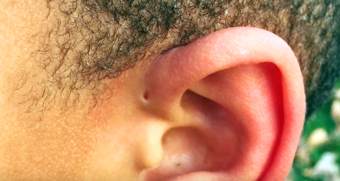 Have You Ever Noticed This Tiny Hole Above Someone's Ear? This Is The ...