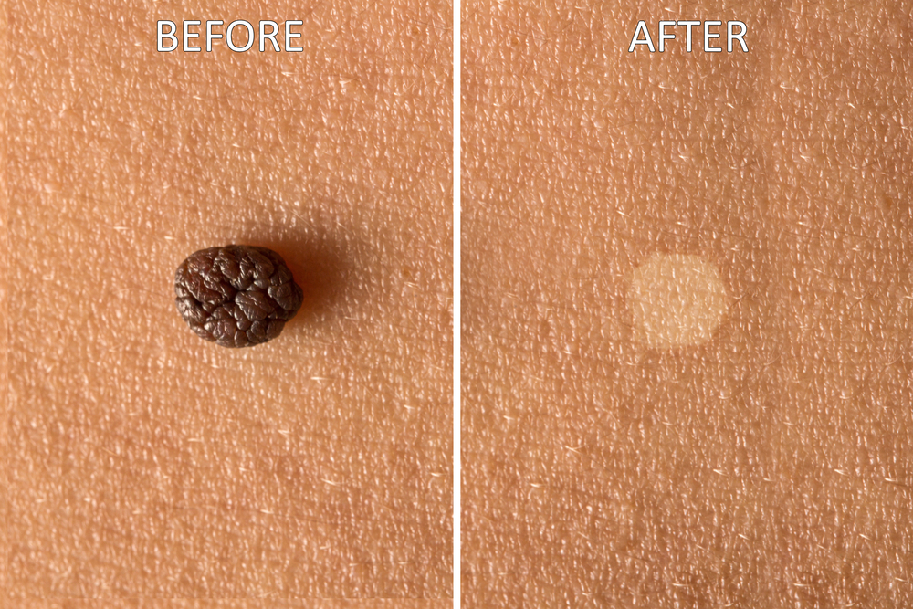 Skin Tags Groin