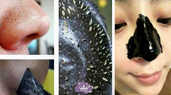 The Easiest Way To Remove Those Gross Blackheads For Good Overnight!