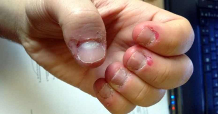 THIS Is The Surprising Reason Why You Should Stop Picking The Skin ...